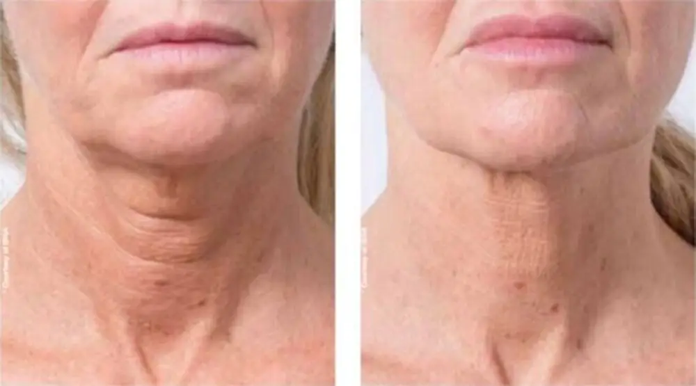 Skin Aesthetics Folkestone & Hythe | Dermal Fillers